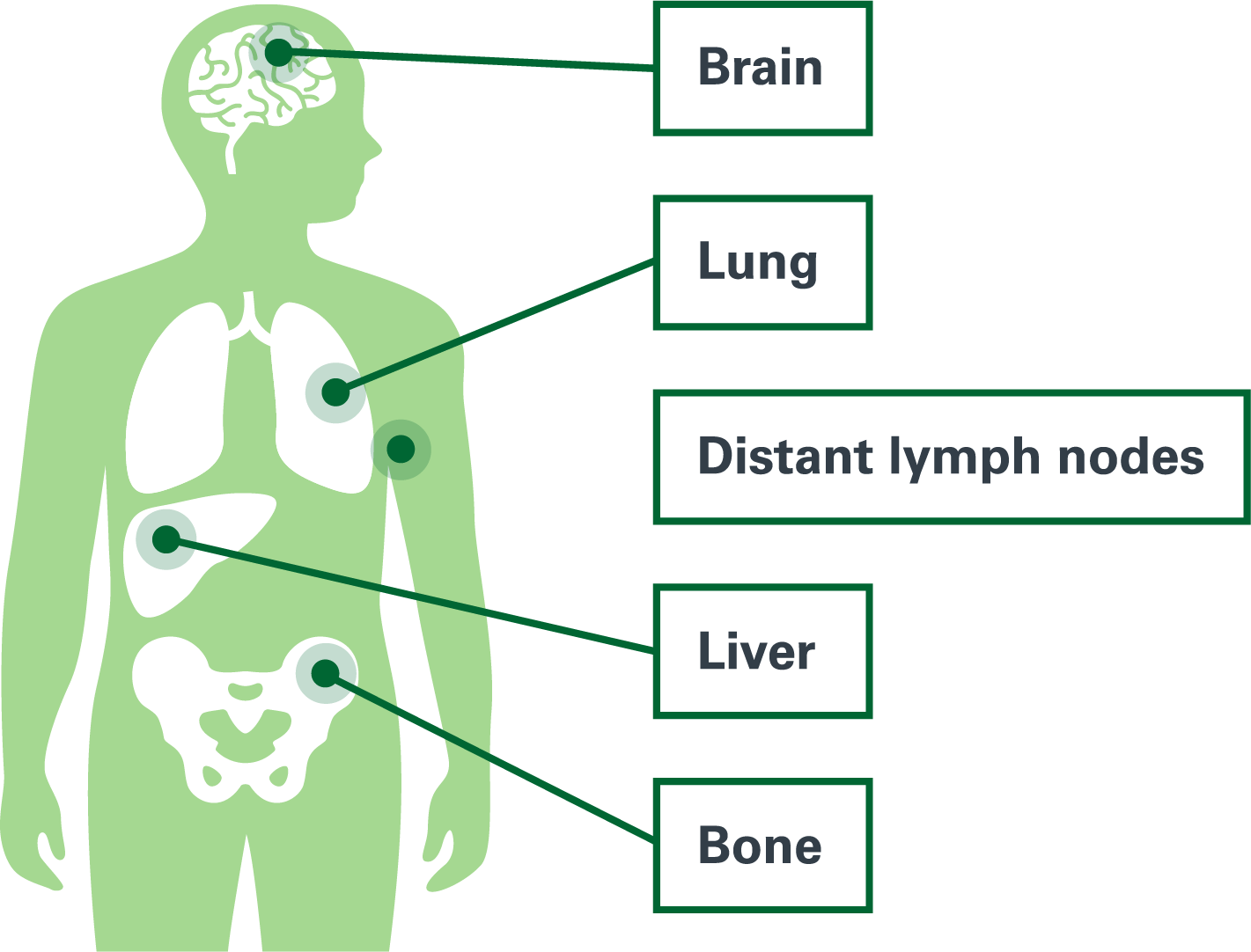 KEYTRUDA in Stage IIB/C melanoma | MSD Connect UK